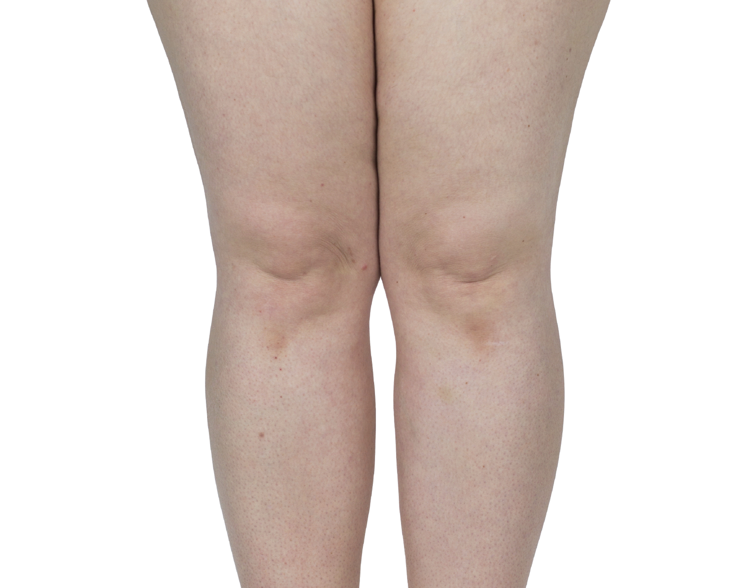 Knee Fat - Humphrey Cosmetic Dermatology
