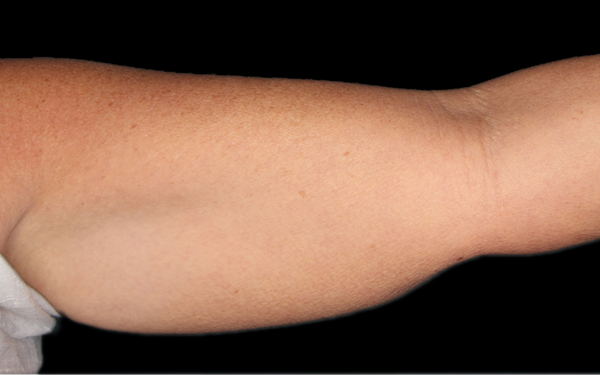 Upper Arm Fat - Humphrey Cosmetic Dermatology